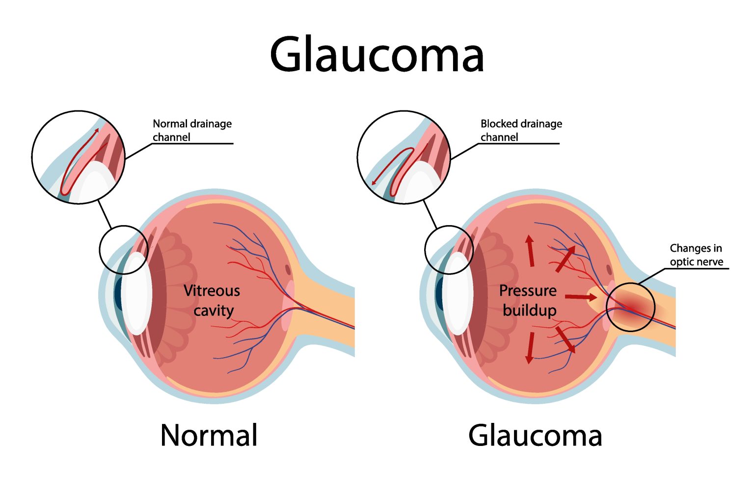 Glaucoma Care & Treatment in Phoenixville | Phoenixville Eye Care