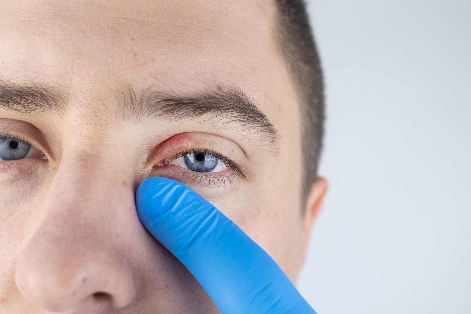 Blepharitis Treatment in Phoenixville | Phoenixville Eye Care